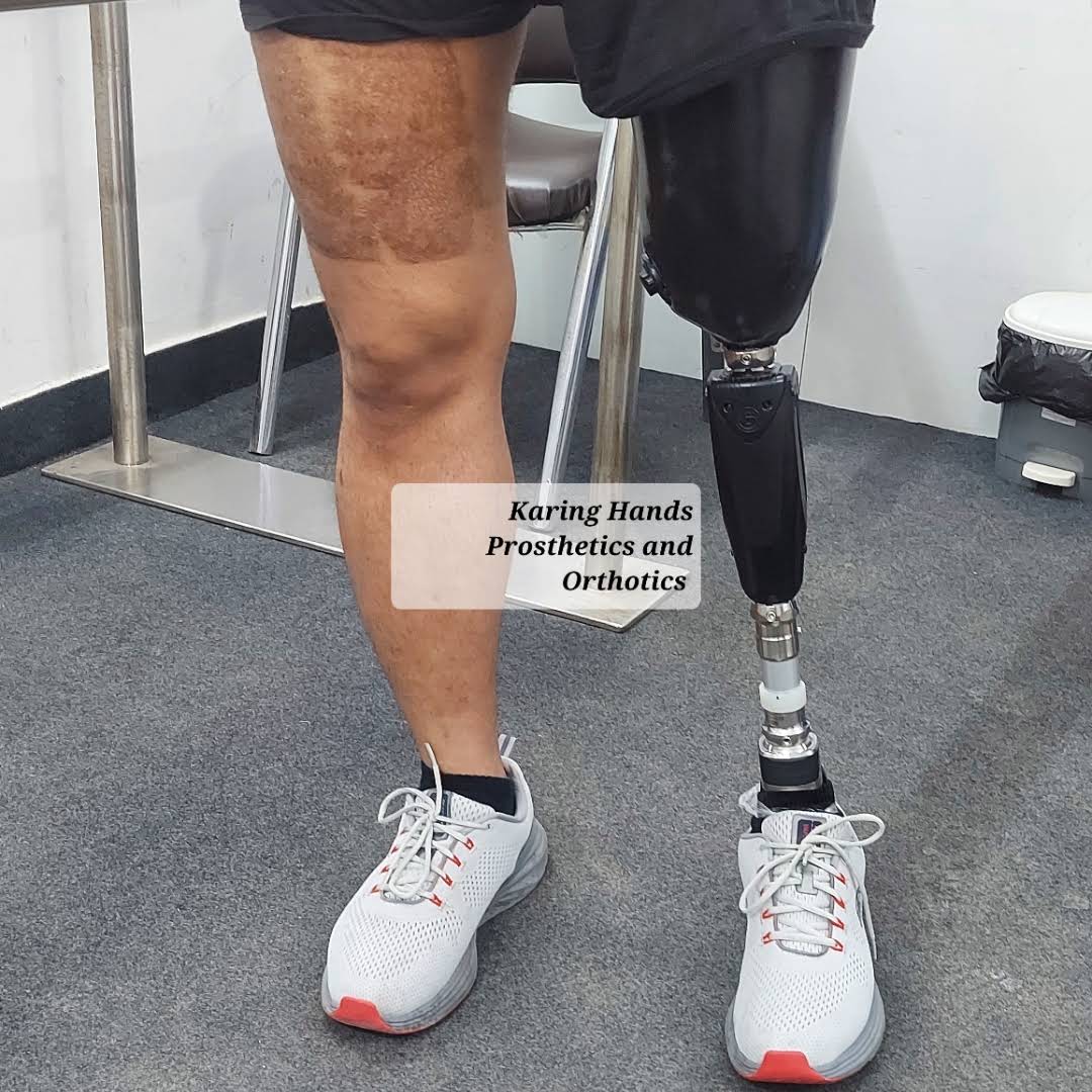 Post from Karing Hands Prosthetics and Orthotics New Delhi.