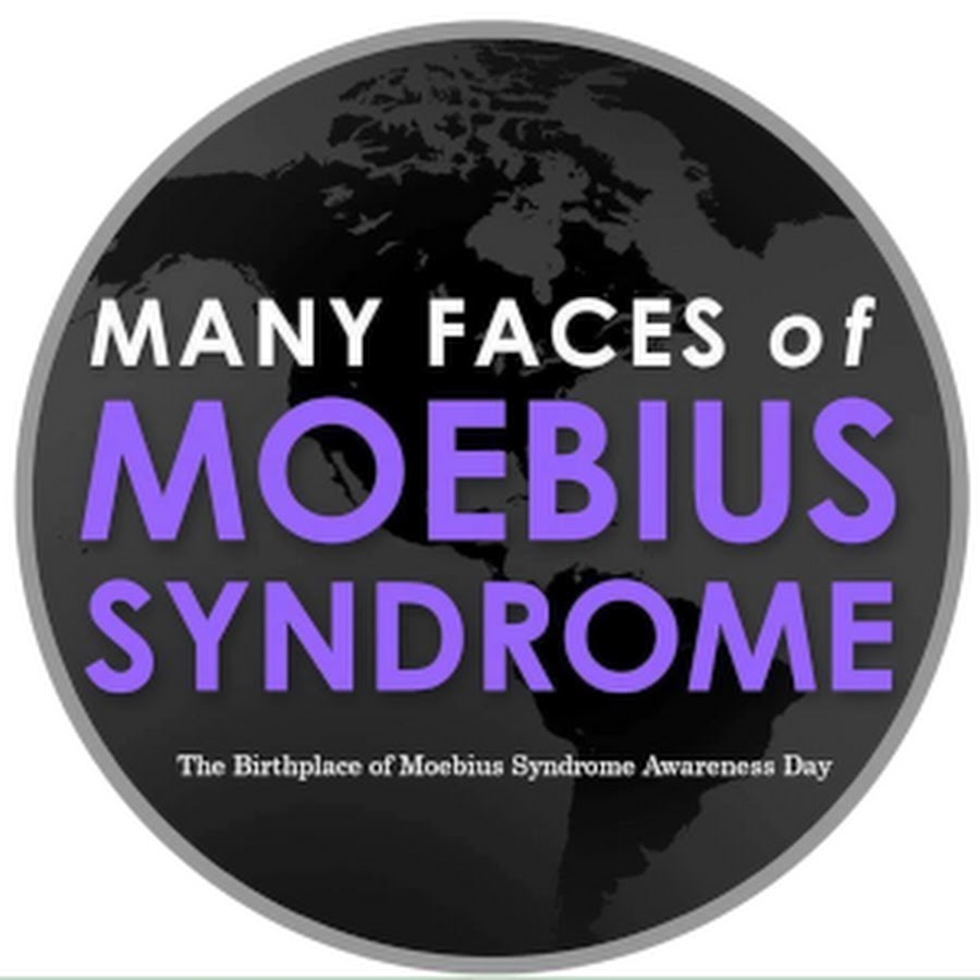 Many Faces of Moebius Syndrome - YouTube
