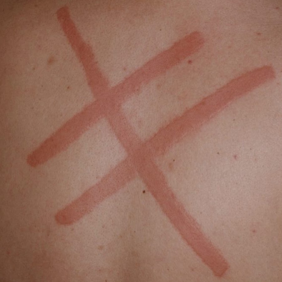 My Dermatographia Journey - YouTube