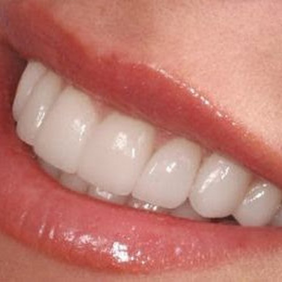 bridge dentaire - YouTube