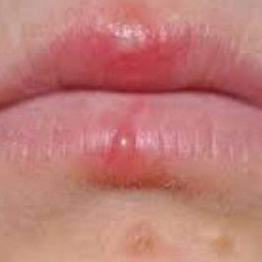 Pimples Explosion - The video - YouTube